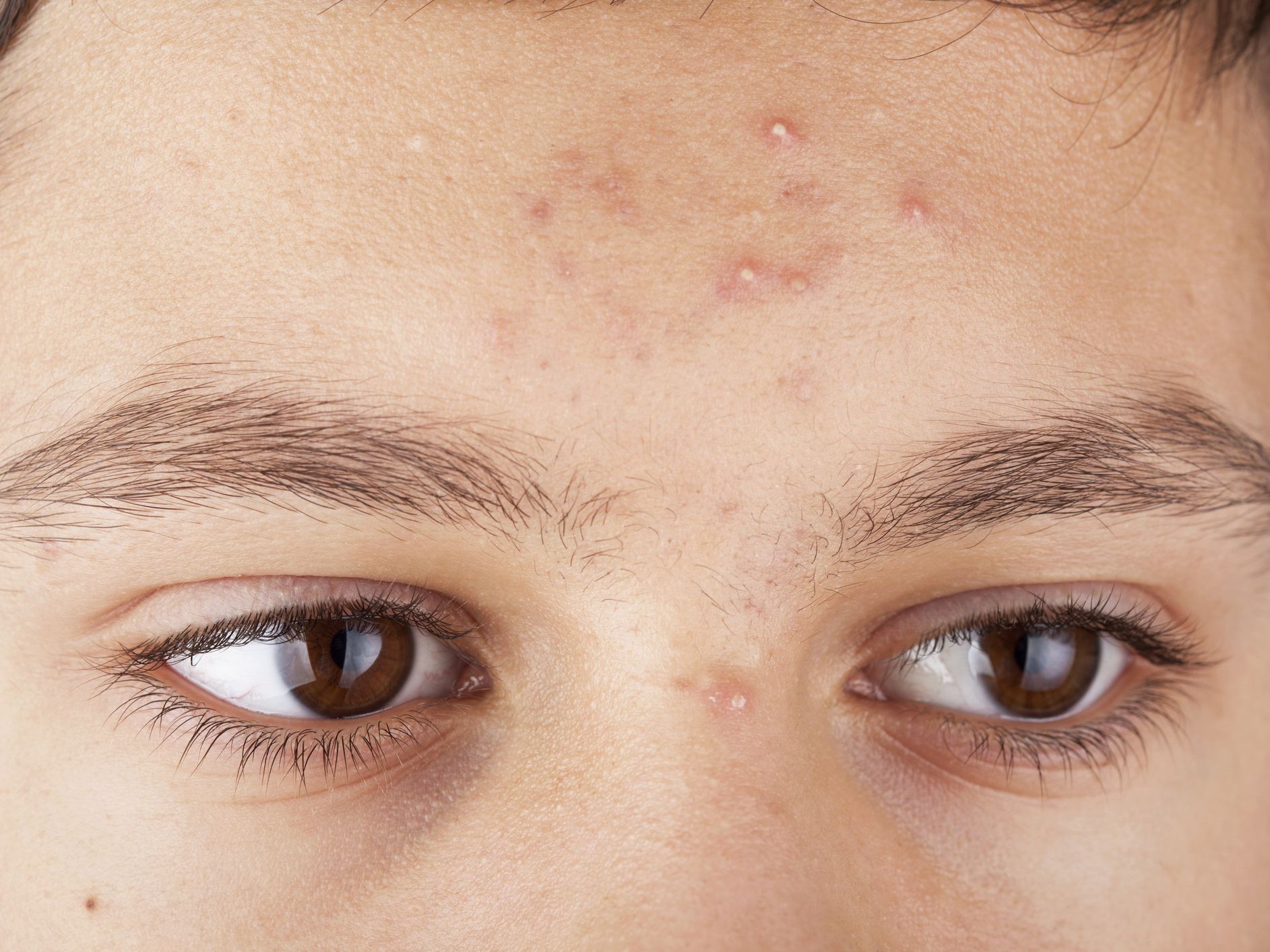 Pustule How To Get Rid Of A Pustule What Causes Pustules Acne Tips Pustule How To Get Rid Of A Pustule What Causes Pustules Acne Tips